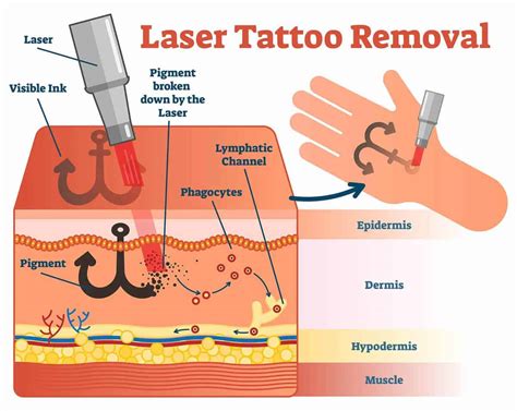 Tattoo Removal Healing Process
