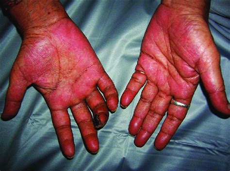 Palmar Erythema Symptoms Causes Treatment And More Wevbz