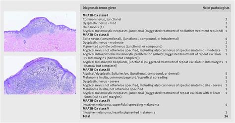 Pathologists Diagnosis Of Invasive Melanoma And Melanocytic