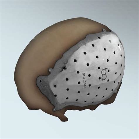 First 3d Printed Titanium Cranial Implant To Get Fda Approval