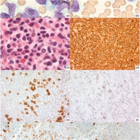 Imaging Serum Immunofixation Testing And Karyotypic Analysis Of The Download Scientific