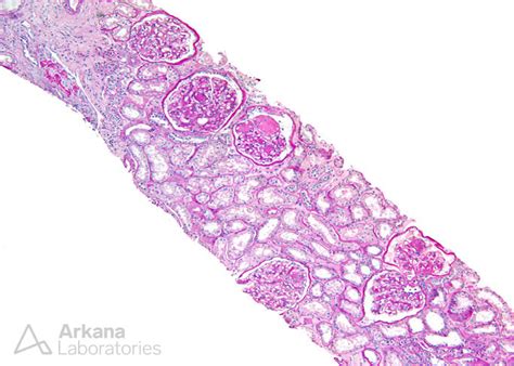 Diffuse And Nodular Glomerulosclerosis Low Pas Ismms Nephrology Fellowship