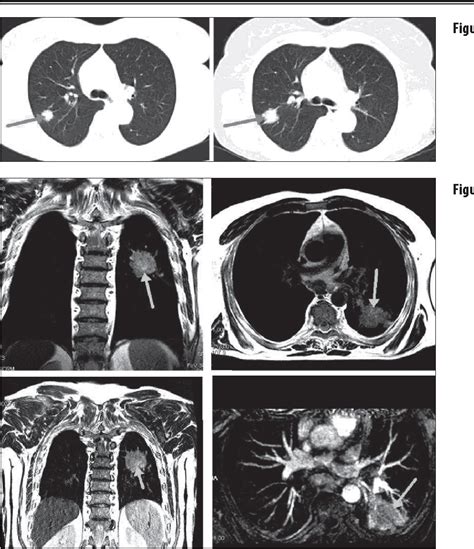 Figure From Lung Cancer Differential Diagnosis Based On The Computer Assisted Radiology The