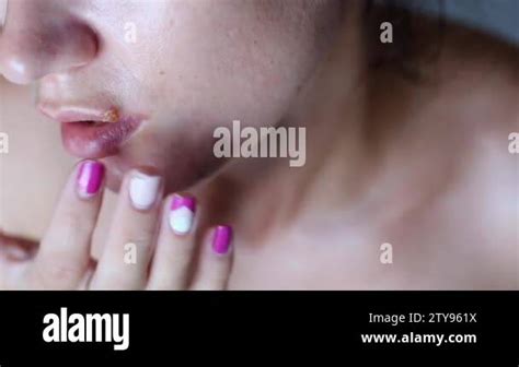 Young Woman With Problematic Skin Touching Sores From Herpes On Her