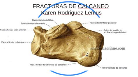 Fracturas De Calcaneo By Karen Rodriguez On Prezi