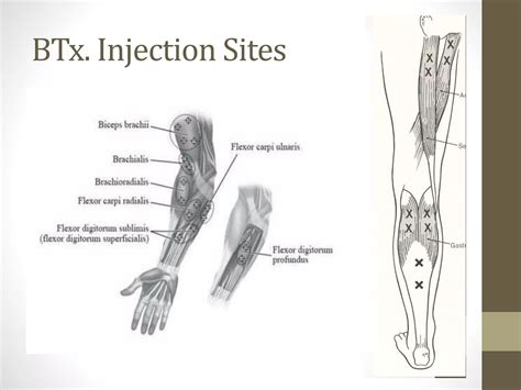 Cerebral Palsy Spasticity Management And Botox Therapy Pptx Physical