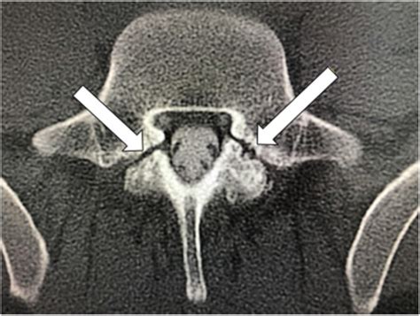 Spinal Cerebrospinal Fluid Leak In The Context Of Pars Interarticularis