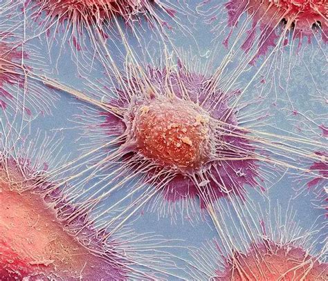Colored Scanning Electron Micrograph Sem Of Squamous Cell Carcinoma Cancer Cells From A