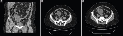 Appendiceal Mucinous Neoplasm A Rare Diagnosis Within Gastrointestinal Tumors Case Report