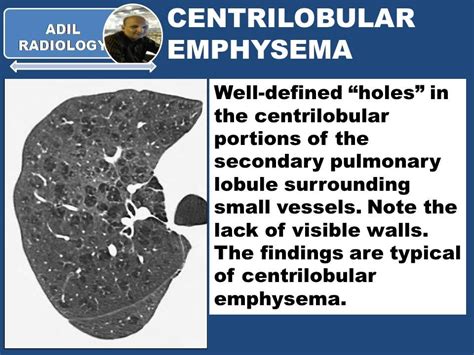 Centrilobular Emphysema Few Radiology Classroom