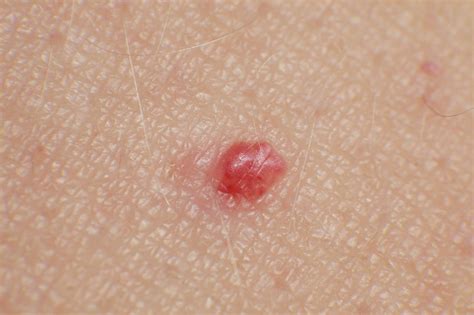 Understanding Cherry Angiomas Causes And Treatment Options