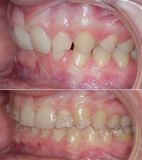 Spark Aligners Clarity…notice The Torque Control Due To Tight Fitting Of The Aligner…not