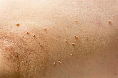 Skin Tags Causes Triggers And Prevention Tips — Clarion Medical