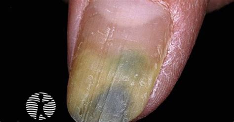 Pseudomonas Nail Image