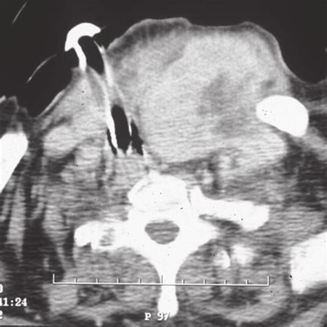 Computed Tomographic Scan Showing An Enlarged Left Thyroid Lobe With A