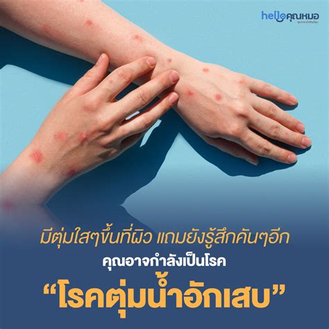 Hello คุณหมอ ผื่นผิวหนังอักเสบชนิดตุ่มใส Dyshidrotic Facebook