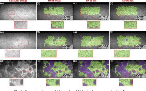 Figure 1 From Corneal Endothelium Assessment In Specular Microscopy Images With Fuchs Dystrophy