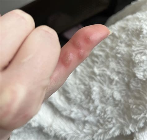 Help Mysterious Blisters On Finger Rdiagnoseme
