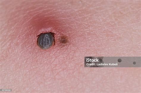 틱 하 고 점입니다 아주 작은 진드기는 반점이와 인간의 피부에 피를 빠 진드기에 대한 스톡 사진 및 기타 이미지 진드기