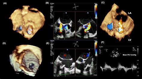 Tee Imaging A 3d‐tee Color Doppler En Face View Shows Severe Download Scientific Diagram