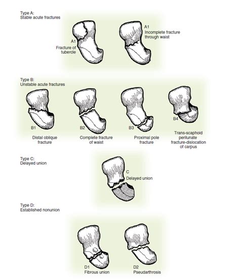 Scaphoid Fracture Of The Wrist 8 Points You Need To Know [ Clinical Cases] Rehand