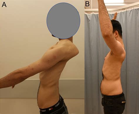 Management Of Scapular Dysfunction In Facioscapulohumeral Muscular