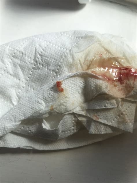 How Does A Miscarriage Look At 6 To 8 Weeks