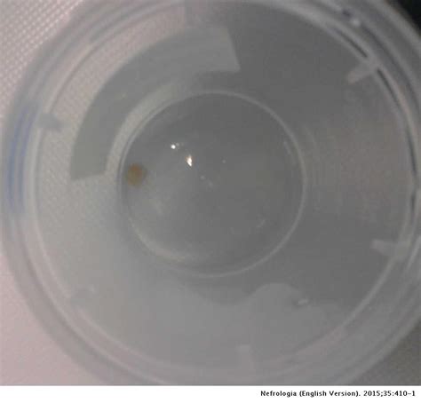 Struvite Urolithiasis With Corynebacterium Urealyticum Infection A Case Report Nefrología