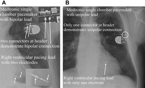 Icd Vs Pacemaker Cxr The Perioperative Management Of Implantable Pacemakers And Cardioverter