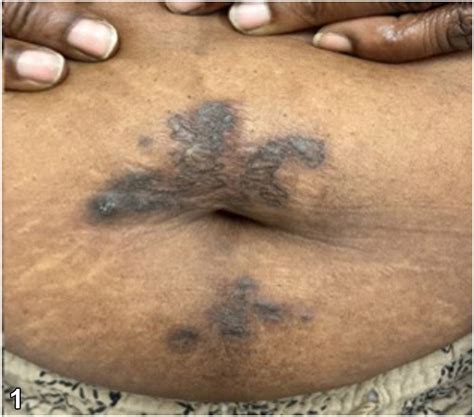 A Patient With Periumbilical Hyperpigmentation And Keratotic Papules