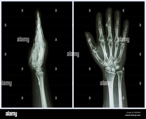 Normal Lateral Finger Xray At Seth Finnan Blog
