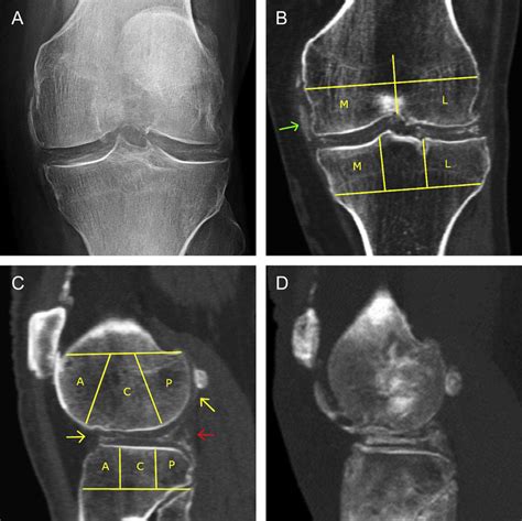 Chondrocalcinosis Vs Normal