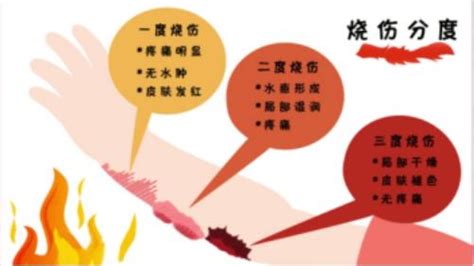 烧烫伤轻重分级要知道，常备京万红科学方法早治疗