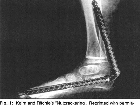 Figure 1 From When Does The Flat Top Talus Lesion Occur In Idiopathic Clubfoot Evaluation With