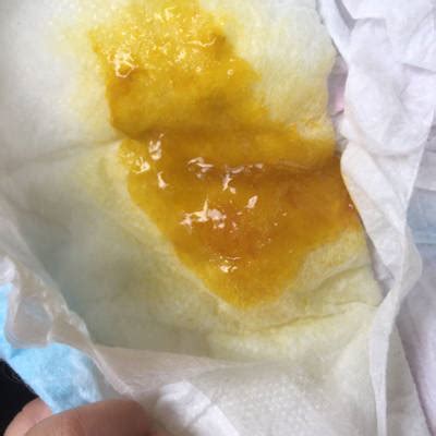 解大便粘稠是什么原因 提前来月经是什么原因 很粘稠 随意云
