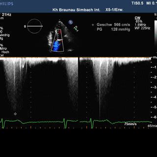 Two Dimensional Color Flow Doppler Echocardiogram Shows Blood Flow Download Scientific Diagram
