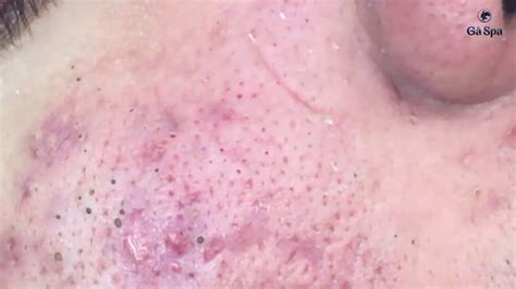 Blackhead Popping Part 1 Youtube
