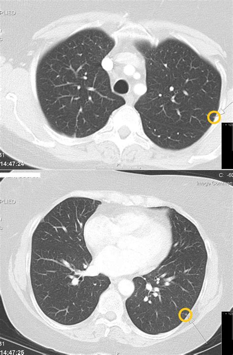 Spiculated Lung Nodule At Brayden Ologhlin Blog