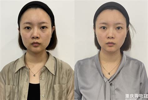 超声炮全模式只要2999？做完两周后，看到这个对比，你心动不？ 变美有招 重庆购物狂