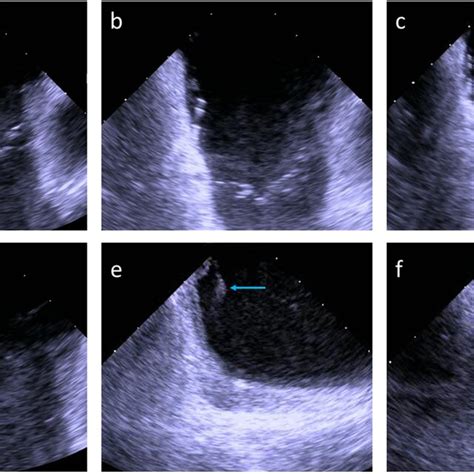 A D Typical Ablation Planes With Cti On The Left Side The Ablation Download Scientific Diagram