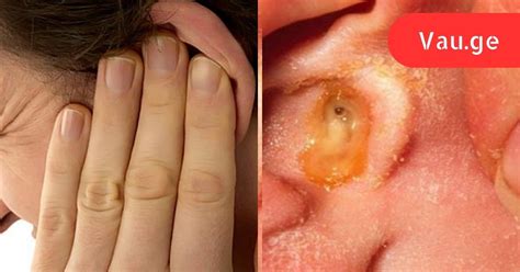 დაემშვიდობეთ ყურის ინფექციებს აი როგორ მარტივად მოიშოროთ პრობლემას მხოლოდ 1 დღეში