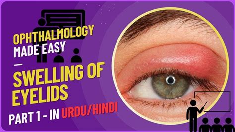 Understanding Eyelid Swellings A Comprehensive Guide To Hordeolum Chalazion Stye And
