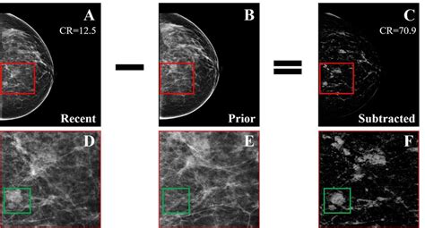 Example Of Temporal Subtraction In A 48 Year Old Woman With A Malignant Download Scientific