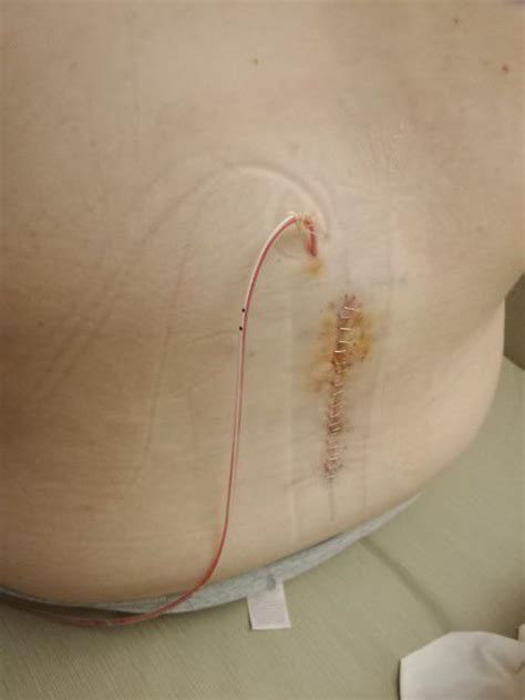 Laminectomy Incision Rmedicalgore