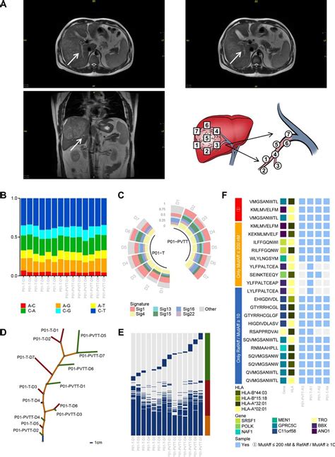 Dominant Neoantigen Verification In Hepatocellular Carcinoma By A Single Plasmid System