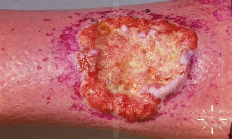 Dermacompass Image Gallery Dermacompass Image Gallery