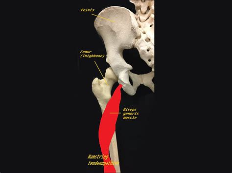 Hamstring Tendonitis Proximal Queensland Lithotripsy Services