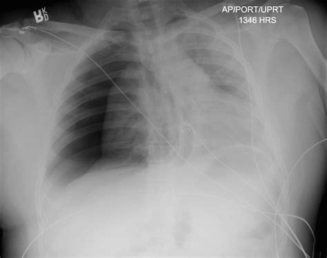 Tension Pneumothorax Needle Decompression