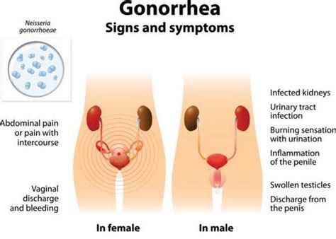 Gonorrhea Clinical Presentation Diagnosis And Treatment Sexually