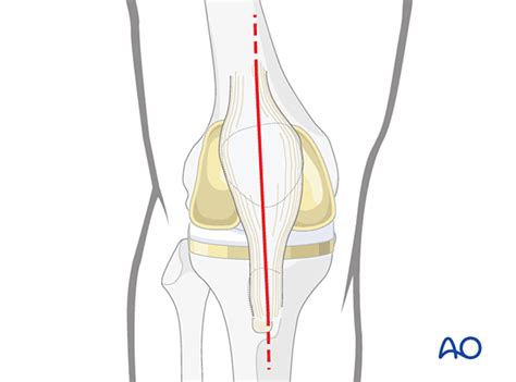 Proximal Tibia Replacement For Fracture Around A Loose Tibial Component